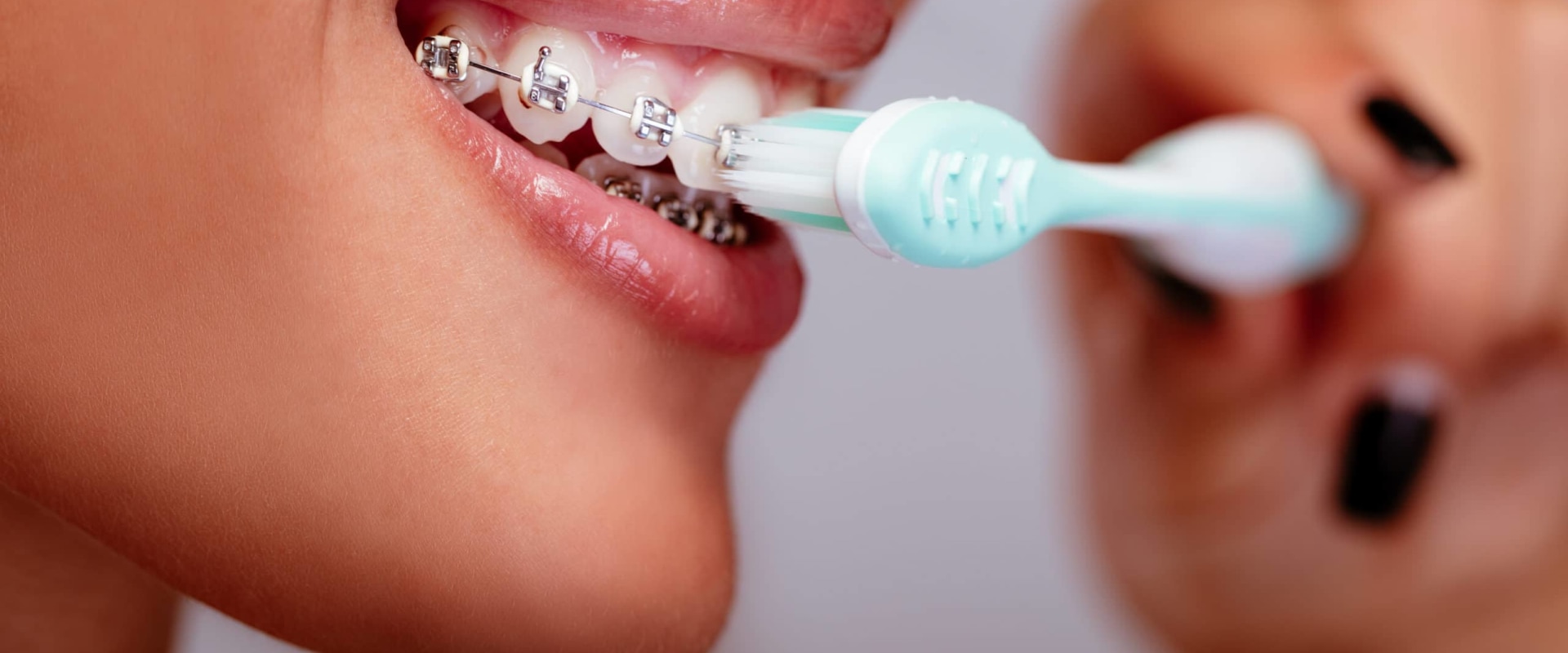 Brushing and Flossing with Braces or Aligners: Expert Tips